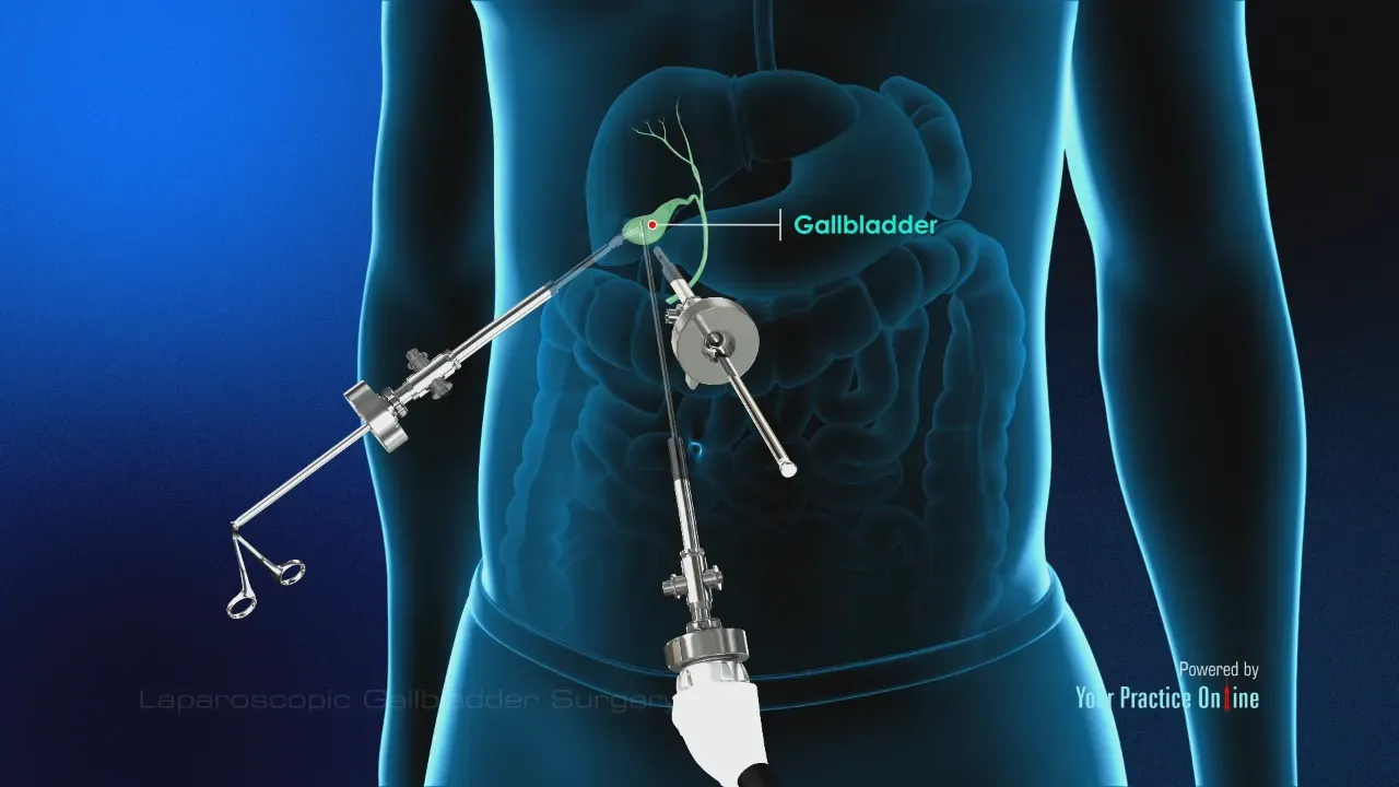 Gallbladder Removal: Are Weight Loss Injections to Blame? - TLC ...